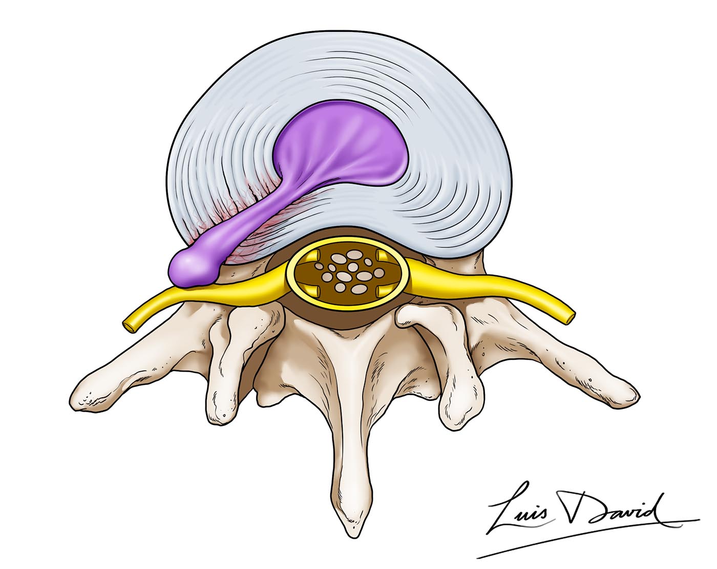 HERNIAS LUMBARES - ILUSTRACIÓN CIENTÍFICA